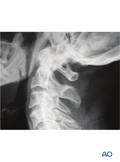 Posterior C1–C2 fusion for Region III Type A: Isolated bony injury of C2