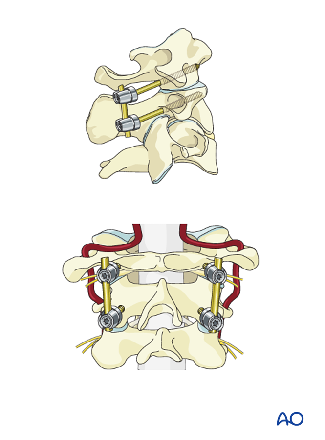Posterior C1–C2 fusion for Region III Type A: Isolated bony injury of C2