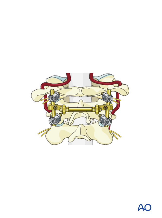 Posterior C1–C2 fusion for Region II Type B: Nondisplaced ligamentous ...