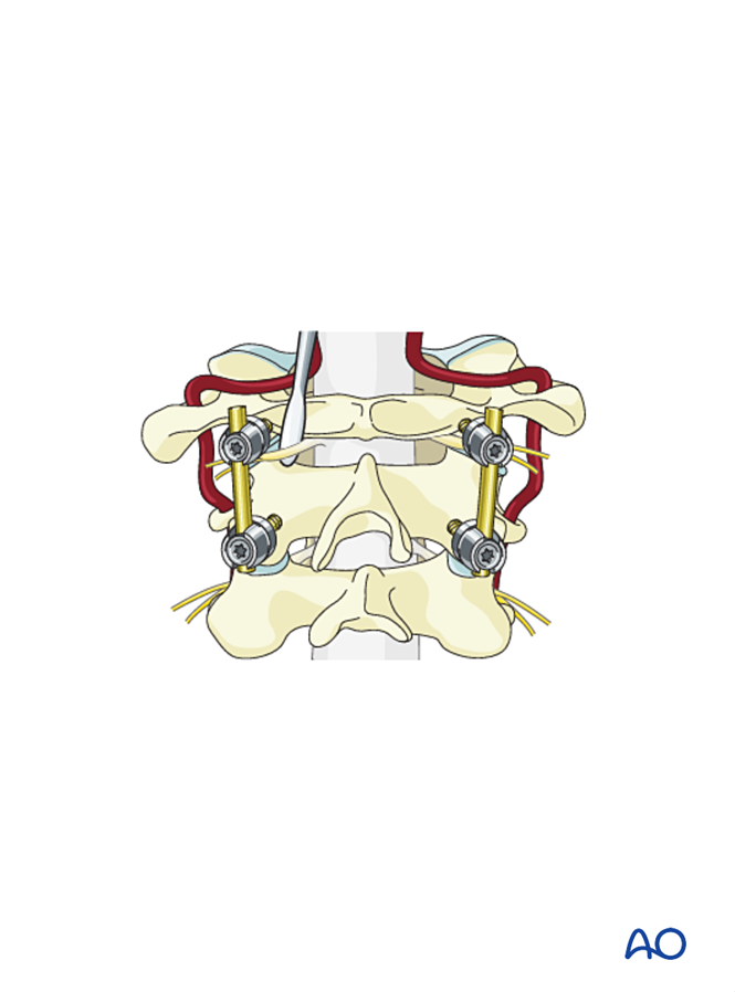 Posterior C1–C2 fusion for Region II Type C: Translation injury of the ...
