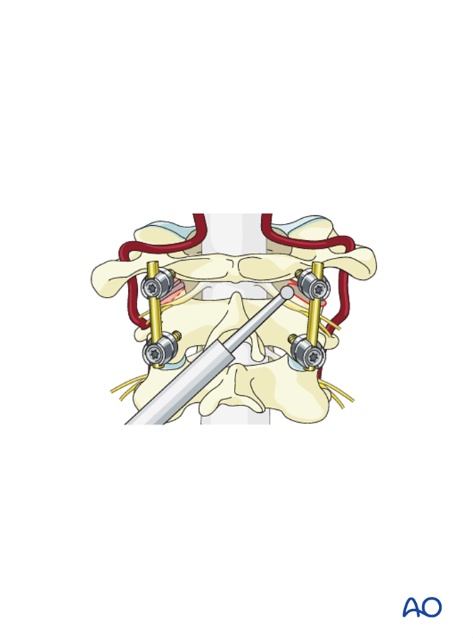 Posterior C1–C2 fusion for Region III Type A: Isolated bony injury of C2