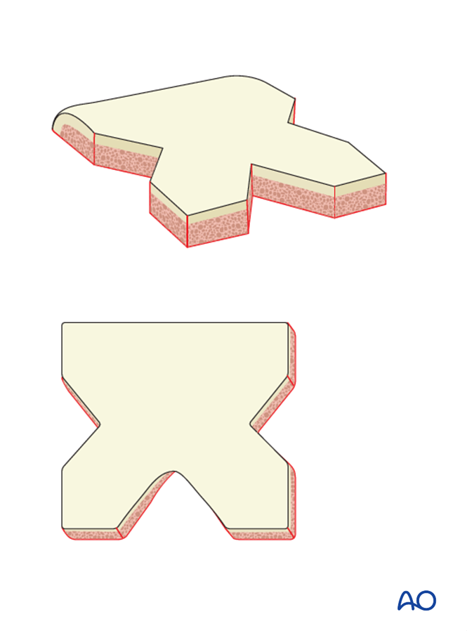 Posterior C1–C2 fusion for Region II Type C: Translation injury of the ...