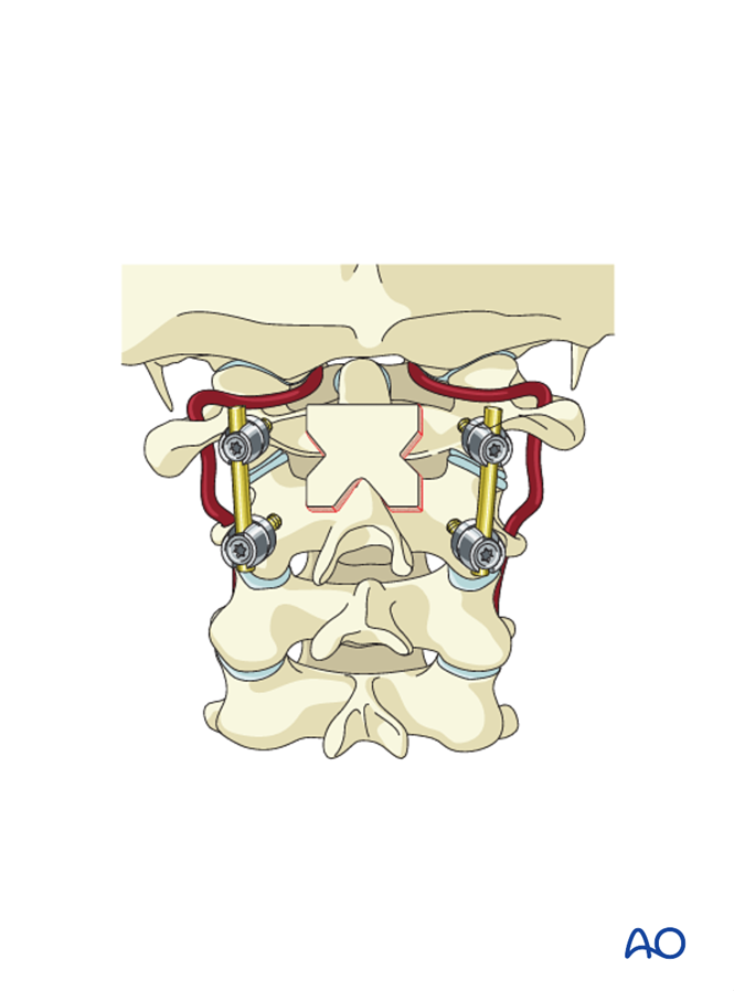 Posterior C1–C2 fusion for Region III Type A: Isolated bony injury of C2