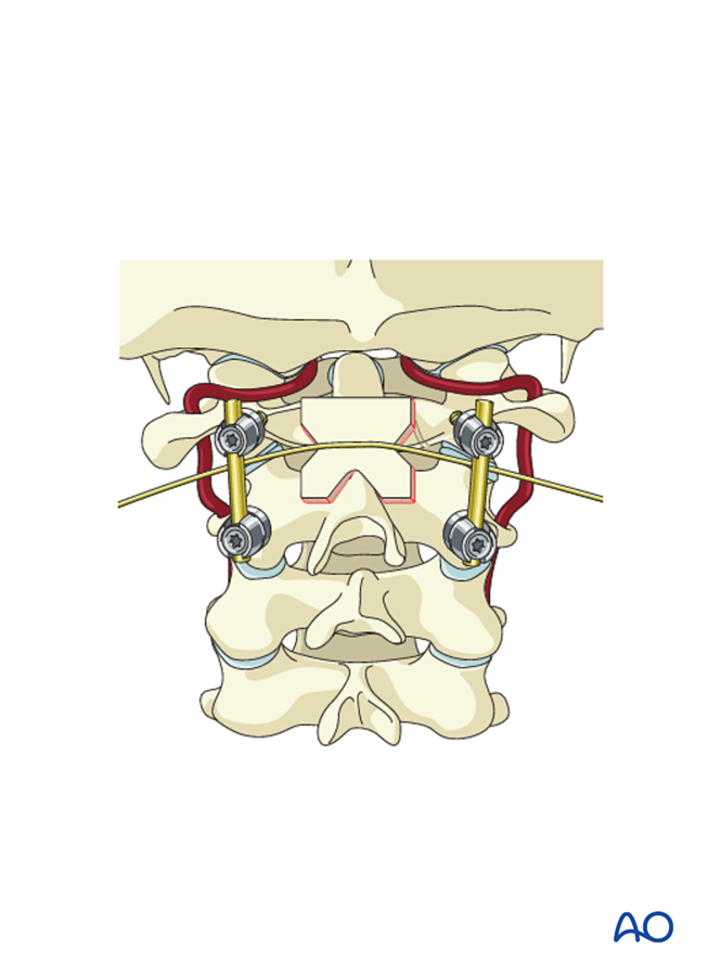 Posterior C1–C2 fusion for Region II Type B: Nondisplaced ligamentous ...