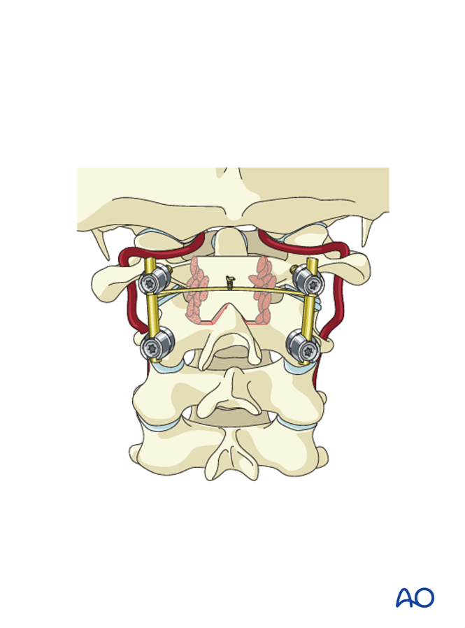 Posterior C1–C2 fusion for Region II Type B: Nondisplaced ligamentous ...