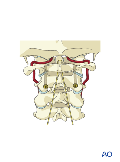 Posterior C1–C2 fusion for Region III Type A: Isolated bony injury of C2