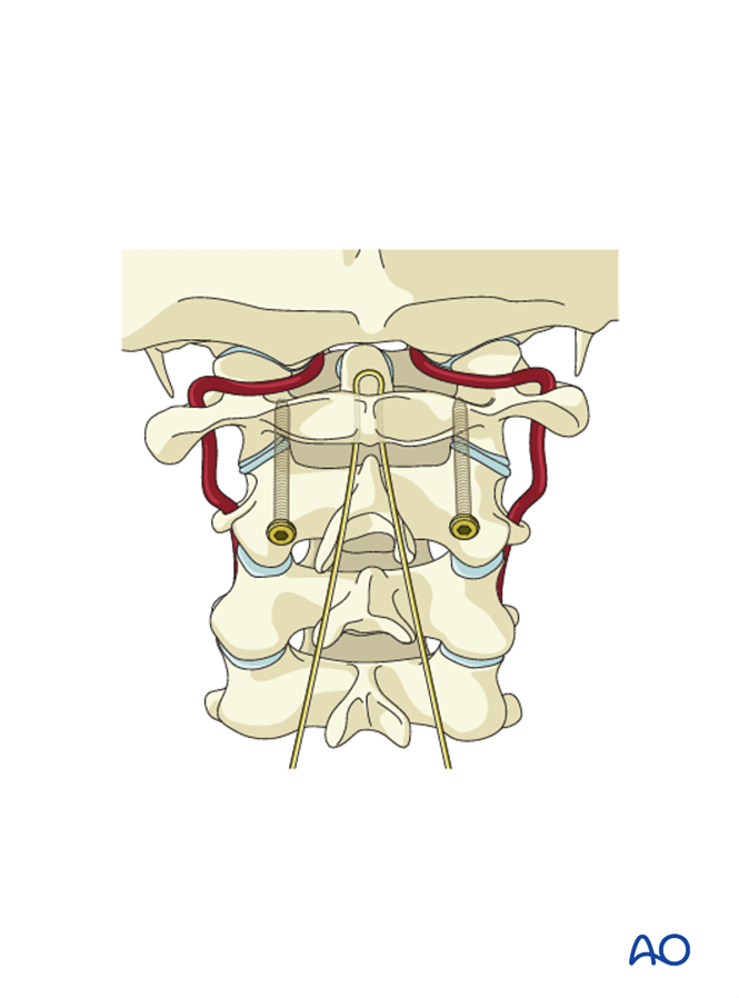Posterior C1–C2 fusion for Region III Type A: Isolated bony injury of C2