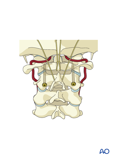 Posterior C1–C2 fusion for Region III Type A: Isolated bony injury of C2