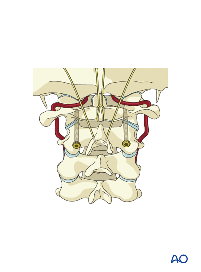 Posterior C1–C2 fusion for Region III Type A: Isolated bony injury of C2