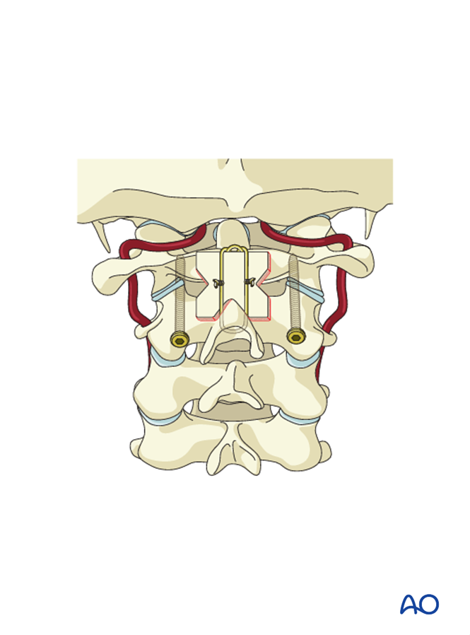 Posterior C1–C2 fusion for Region III Type A: Isolated bony injury of C2