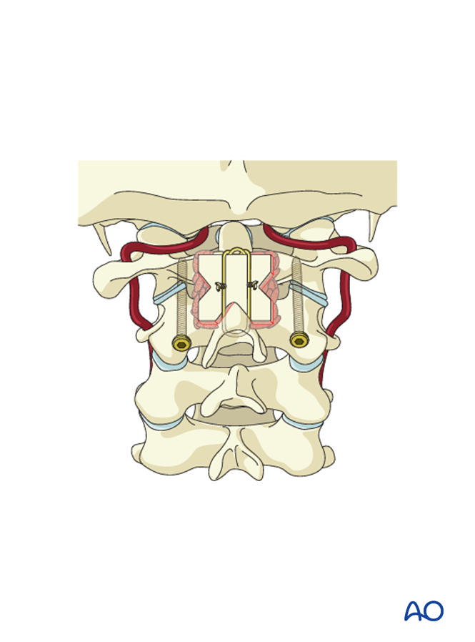 Posterior C1–C2 fusion for Region III Type A: Isolated bony injury of C2