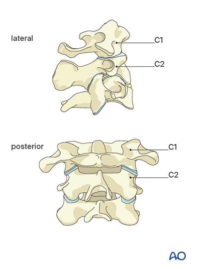Posterior C1–C2 fusion for Region II Type B: Nondisplaced ligamentous ...