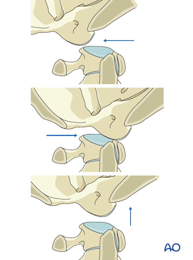 Occipitocervical fusion IIC for Region II Type C: Translation injury of ...