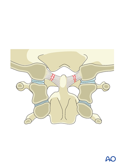 Occipitocervical fusion IB and IC for Region I Type C: Any injury with ...
