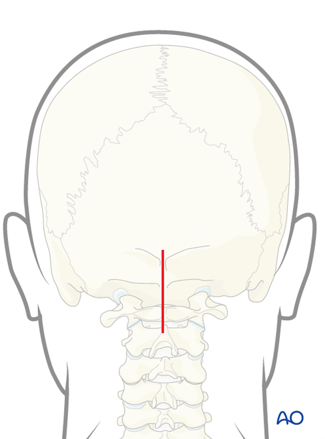 Occipitocervical fusion IB and IC for Region I Type C: Any injury with ...