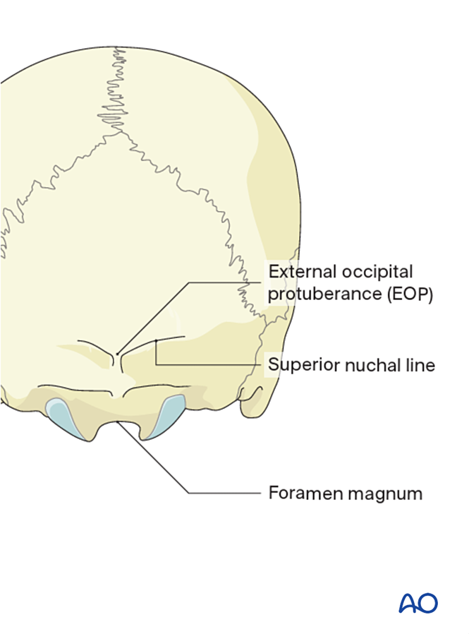 Occipitocervical fusion IB and IC for Region I Type C: Any injury with ...