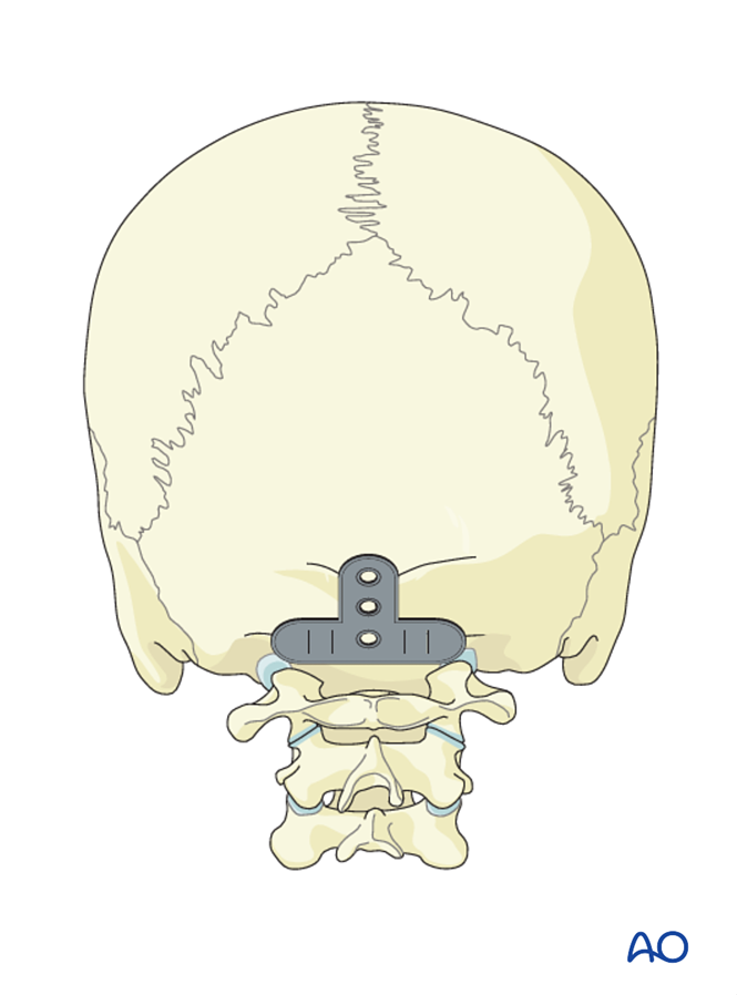 Occipitocervical fusion IIC for Region II Type C: Translation injury of ...