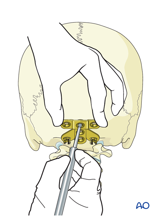Occipitocervical fusion IB and IC for Region I Type C: Any injury with ...