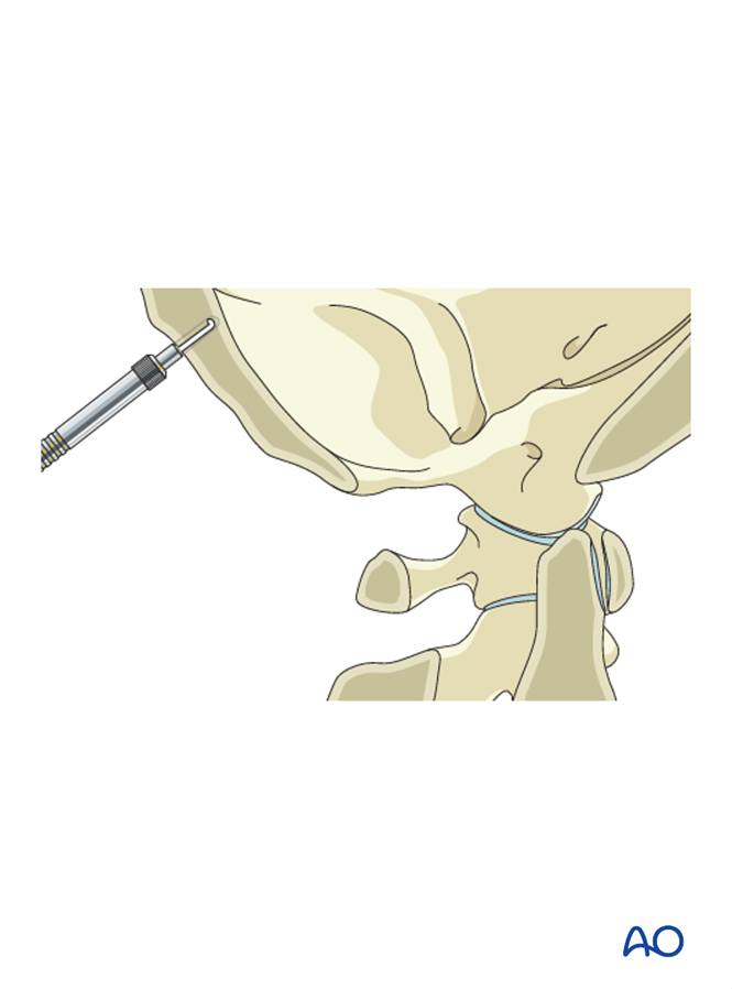 Occipitocervical fusion IB and IC for Region I Type C: Any injury with ...