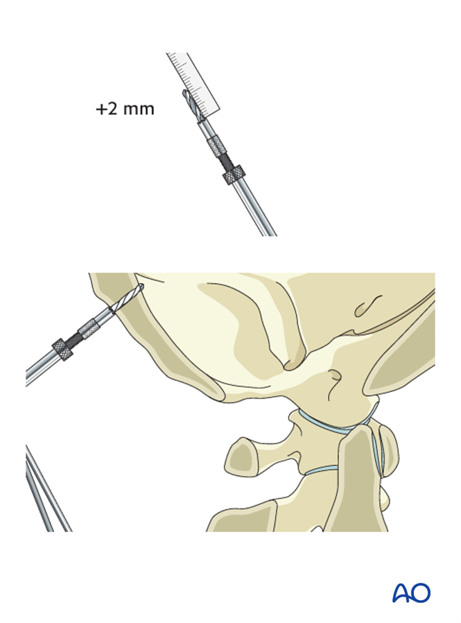 Occipitocervical fusion IIC for Region II Type C: Translation injury of ...