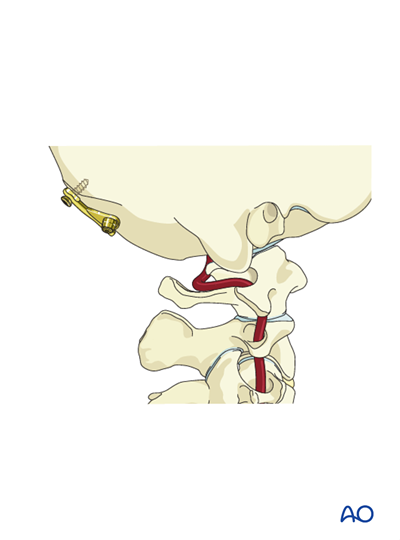 Occipitocervical fusion IB and IC for Region I Type C: Any injury with ...