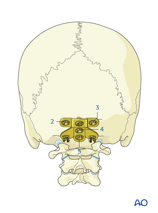 Occipitocervical fusion IB and IC for Region I Type C: Any injury with ...