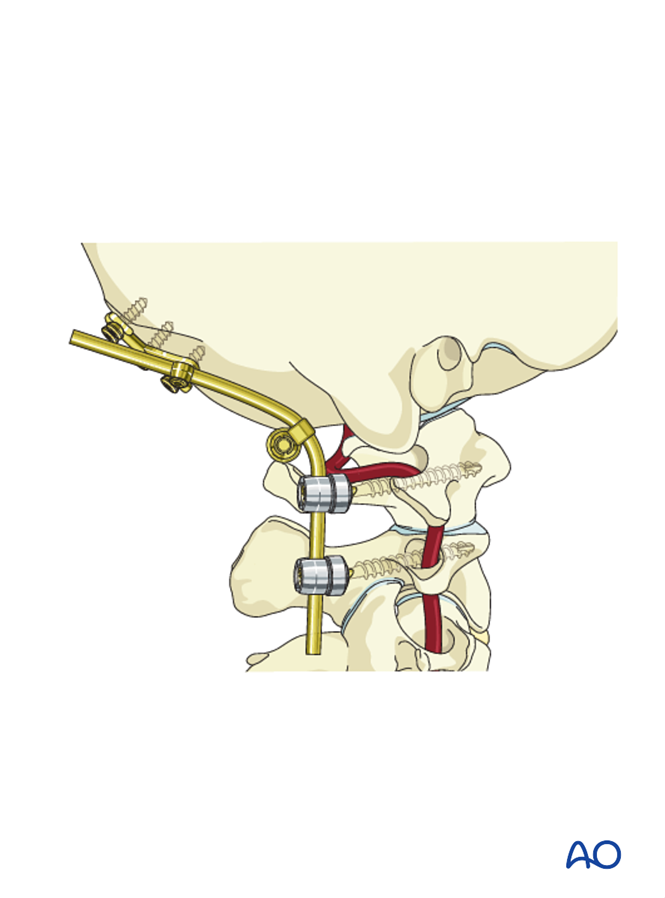 Occipitocervical fusion IB and IC for Region I Type C: Any injury with ...