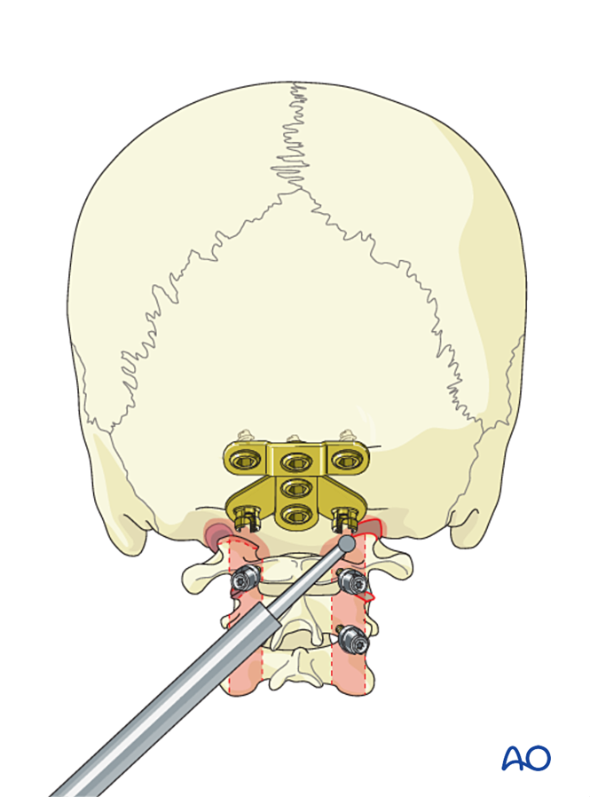 Occipitocervical fusion IIC for Region II Type C: Translation injury of ...