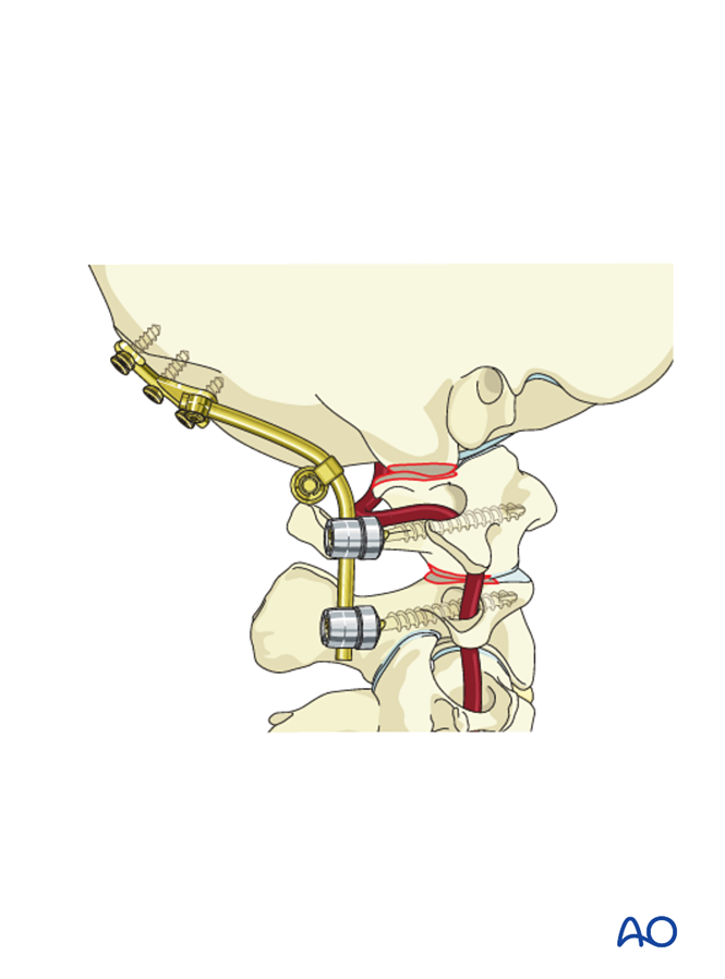 Occipitocervical fusion IB and IC for Region I Type C: Any injury with ...