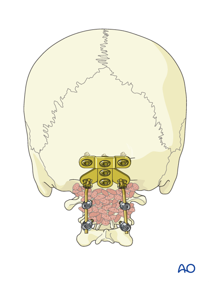 Occipitocervical fusion IB and IC for Region I Type C: Any injury with ...