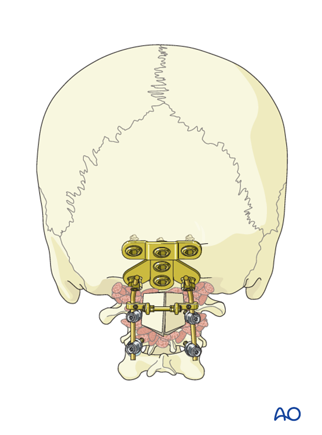 Occipitocervical fusion IB and IC for Region I Type C: Any injury with ...