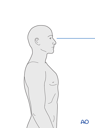 Occipitocervical fusion IB and IC for Region I Type C: Any injury with ...