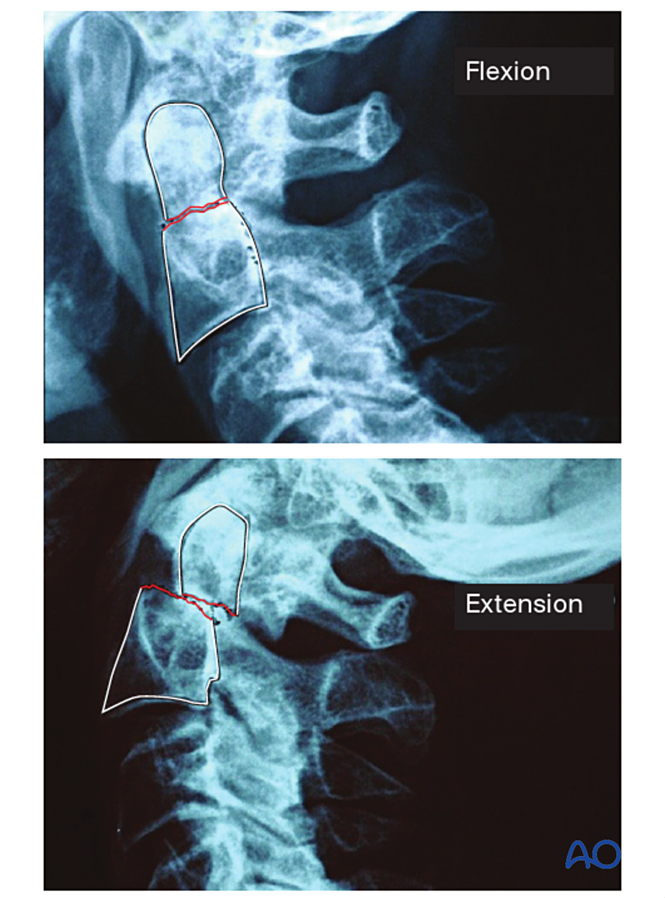 Anterior odontoid screw for Region III Type A: Isolated bony injury of C2