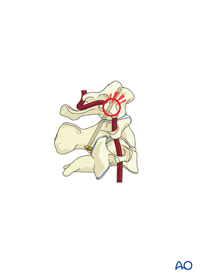 Posterior C1–C2 fusion for Region III Type A: Isolated bony injury of C2