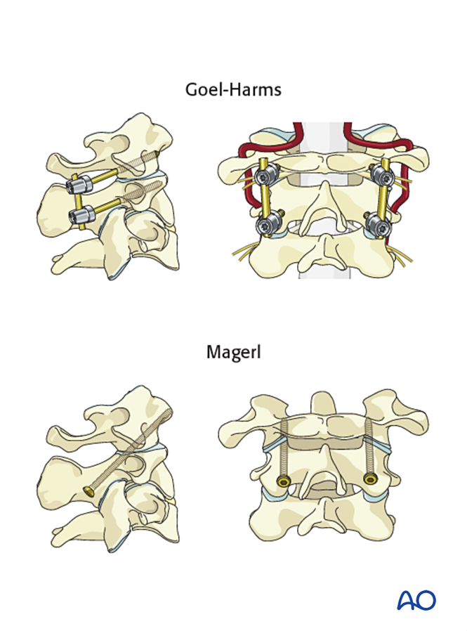 Posterior C1–C2 fusion for Region III Type A: Isolated bony injury of C2