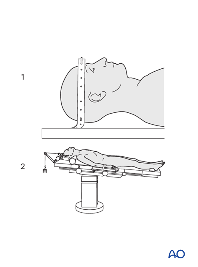Posterior C1–C2 fusion for Region III Type A: Isolated bony injury of C2
