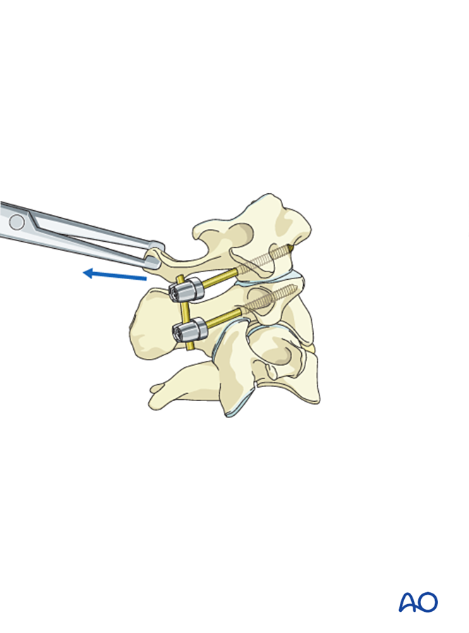 Posterior C1–C2 fusion for Region III Type A: Isolated bony injury of C2