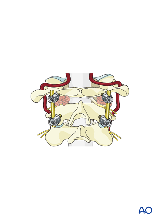 Posterior C1–C2 fusion for Region III Type A: Isolated bony injury of C2