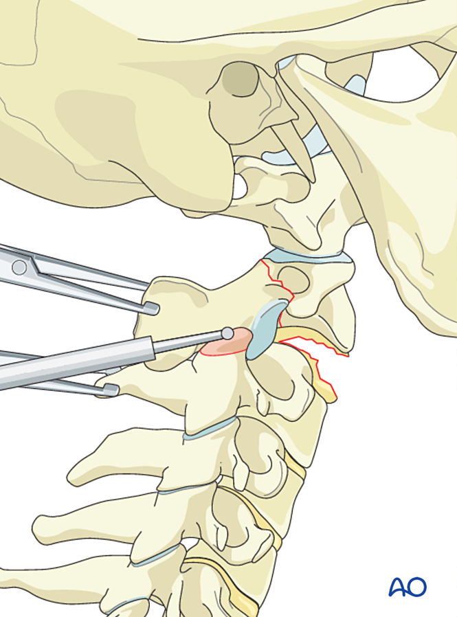 Posterior C2–C3 fusion for Region III Type C: Translation injury