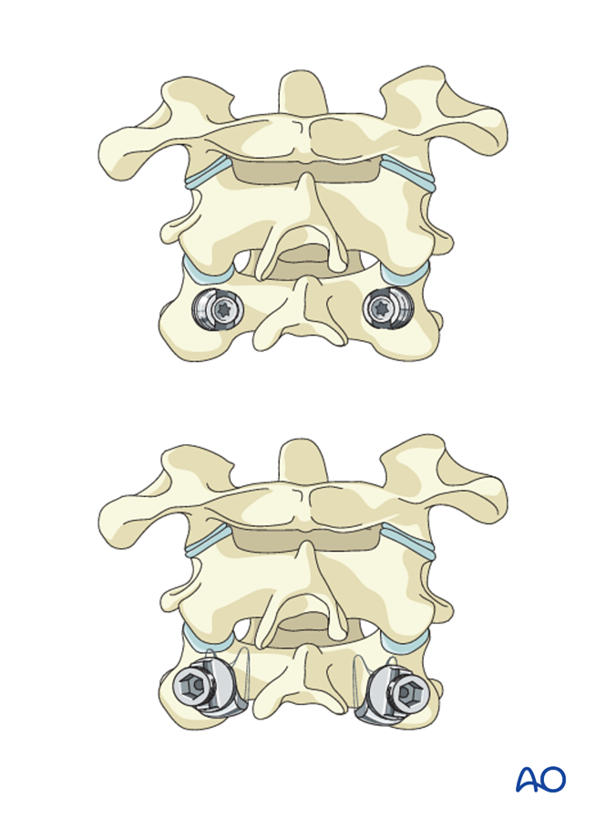 Posterior C2–C3 fusion for Region III Type B: Nondisplaced ligamentous ...
