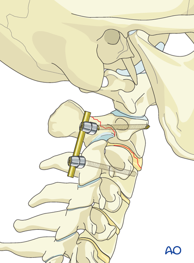Posterior C2–C3 fusion for Region III Type B: Nondisplaced ligamentous ...