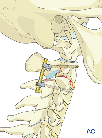 Posterior C2–C3 fusion for Region III Type C: Translation injury