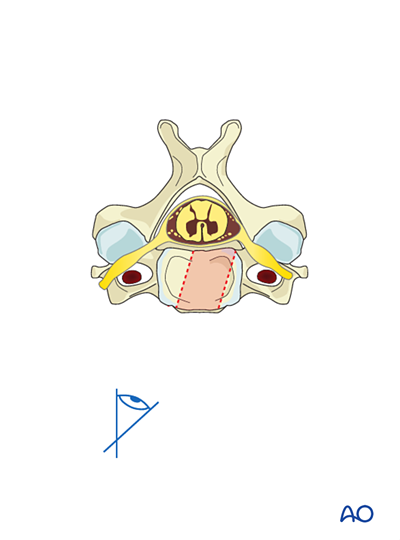 Anterior C2–C3 fusion for Region III Type B: Nondisplaced ligamentous ...