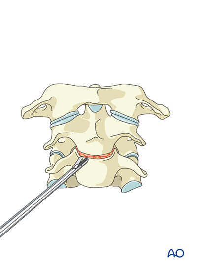 Anterior C2–C3 fusion for Region III Type B: Nondisplaced ligamentous ...