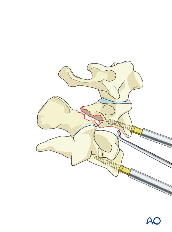 Anterior C2–C3 fusion for Region III Type B: Nondisplaced ligamentous ...