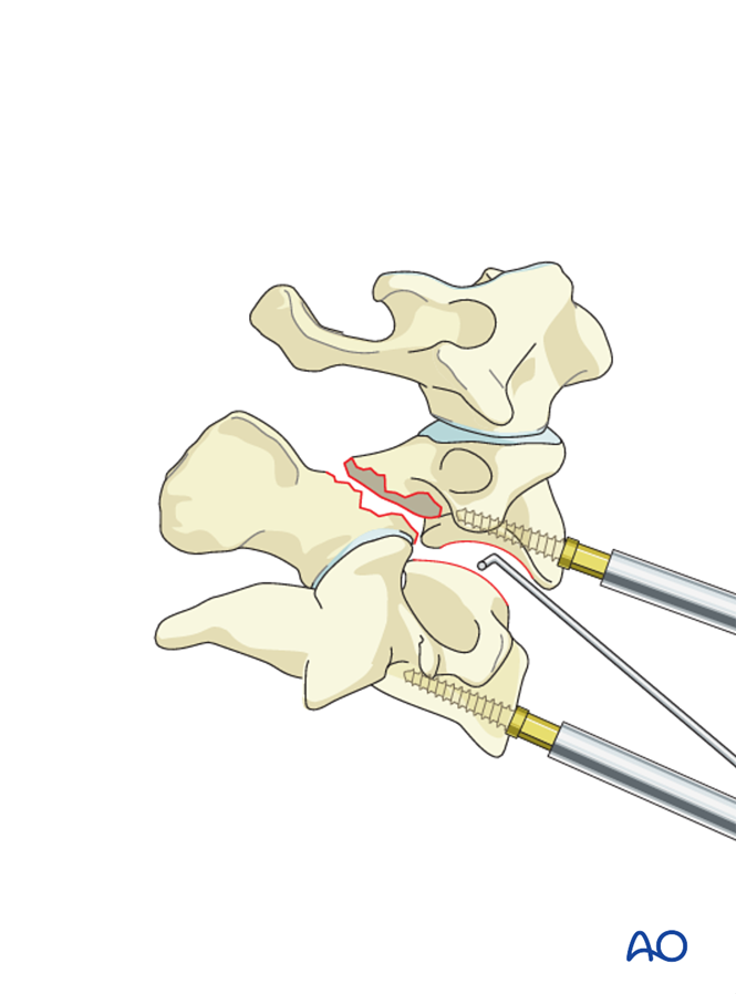 Anterior C2–C3 fusion for Region III Type B: Nondisplaced ligamentous ...