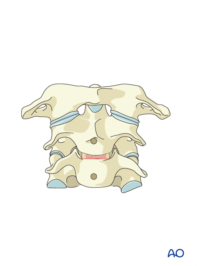 Anterior C2–C3 fusion for Region III Type B: Nondisplaced ligamentous ...