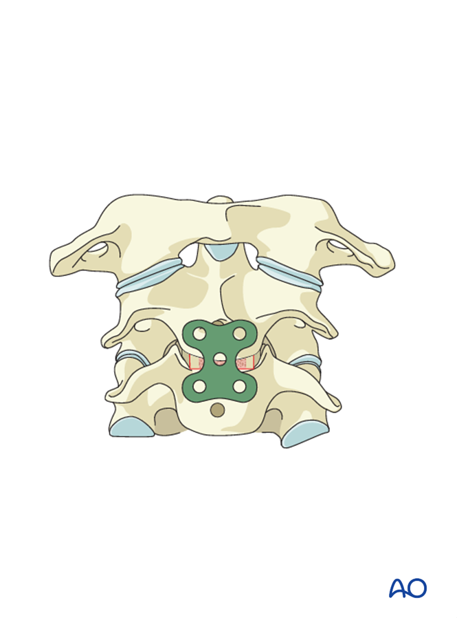 Anterior C2–C3 fusion for Region III Type B: Nondisplaced ligamentous ...