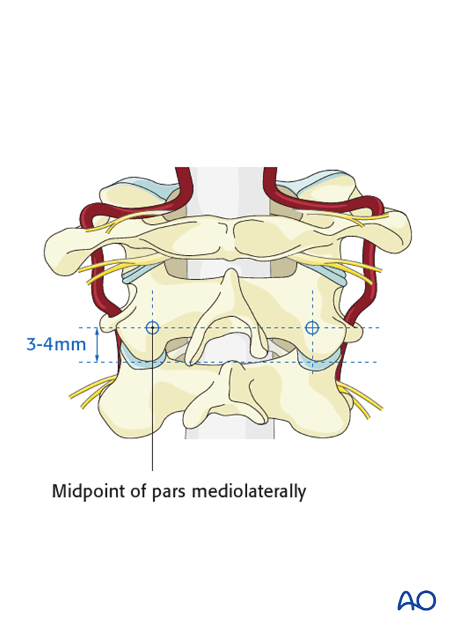 Transarticular screw insertion
