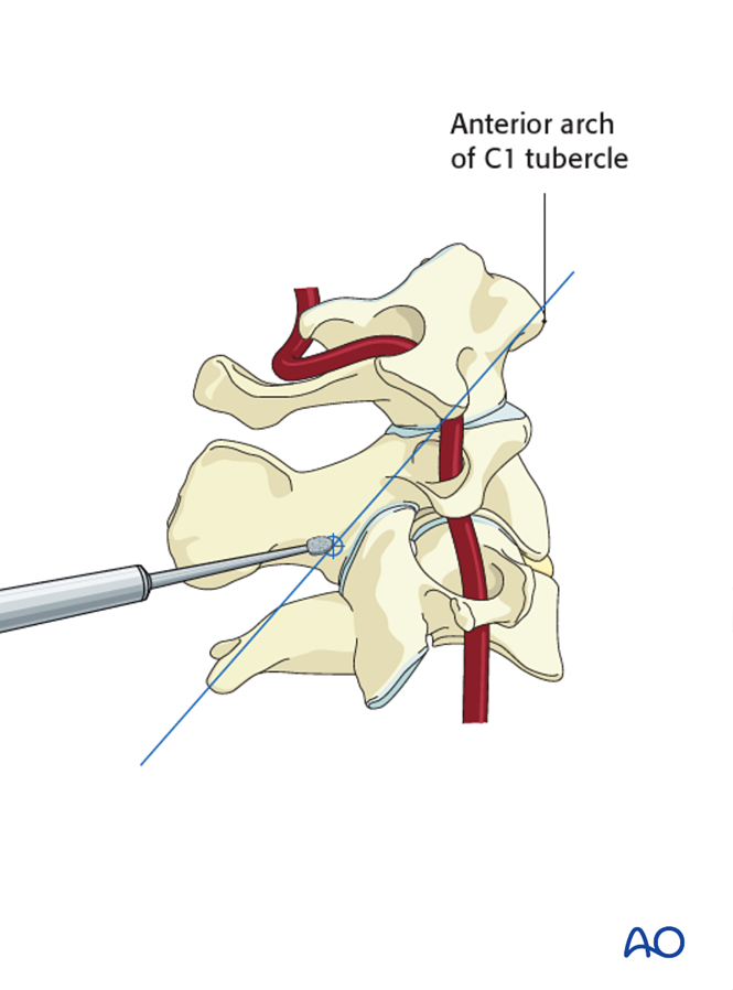 Transarticular screw insertion